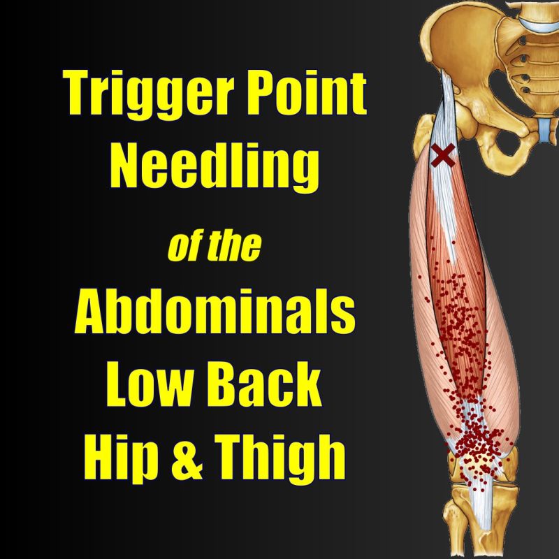 Trigger Point Needling of the Abdominals, Low Back, Hip & Thigh ...